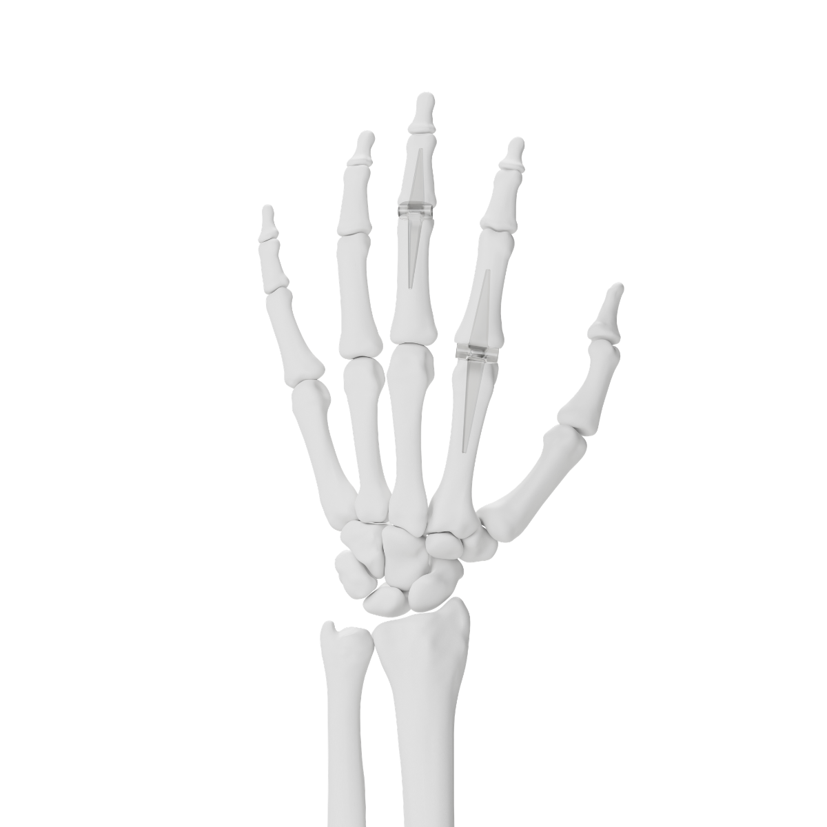 Osteotec Silicone Finger Implant - Osteotec