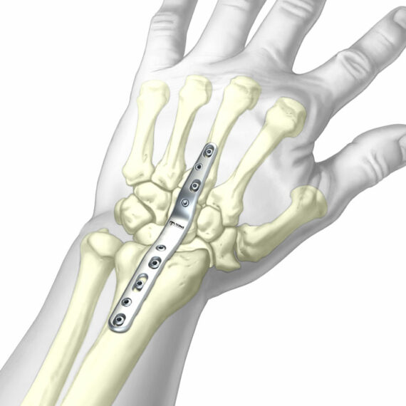 Volar Hook Plate - Osteotec